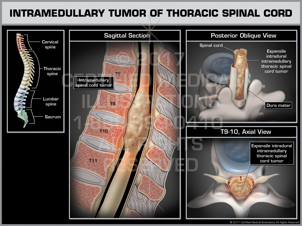 Spine cancer - nipodspecial