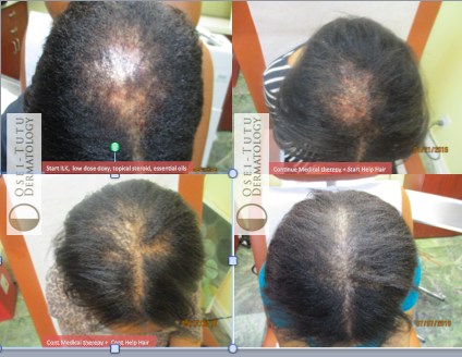 Central Centrifugal Cicatricial Alopecia (CCCA). What is CCCA? - Help Hair