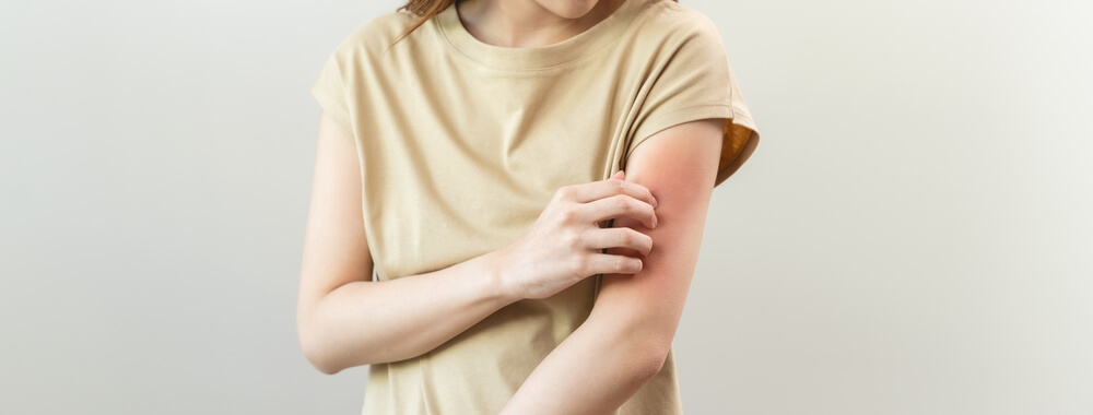 What Skin Rashes Can CBD Topicals Help Treat? - The Vape Mall