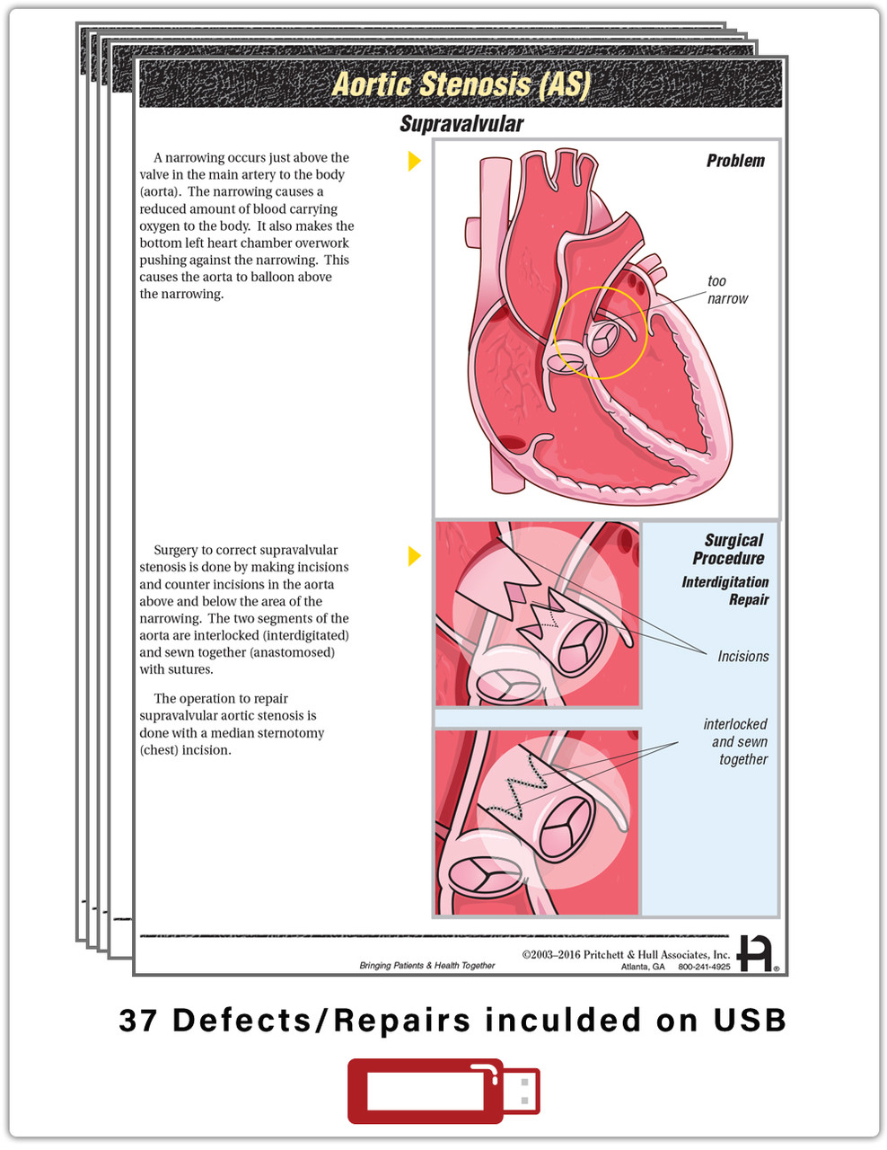 Heart Defect Teaching Sheets - Pritchett and Hull