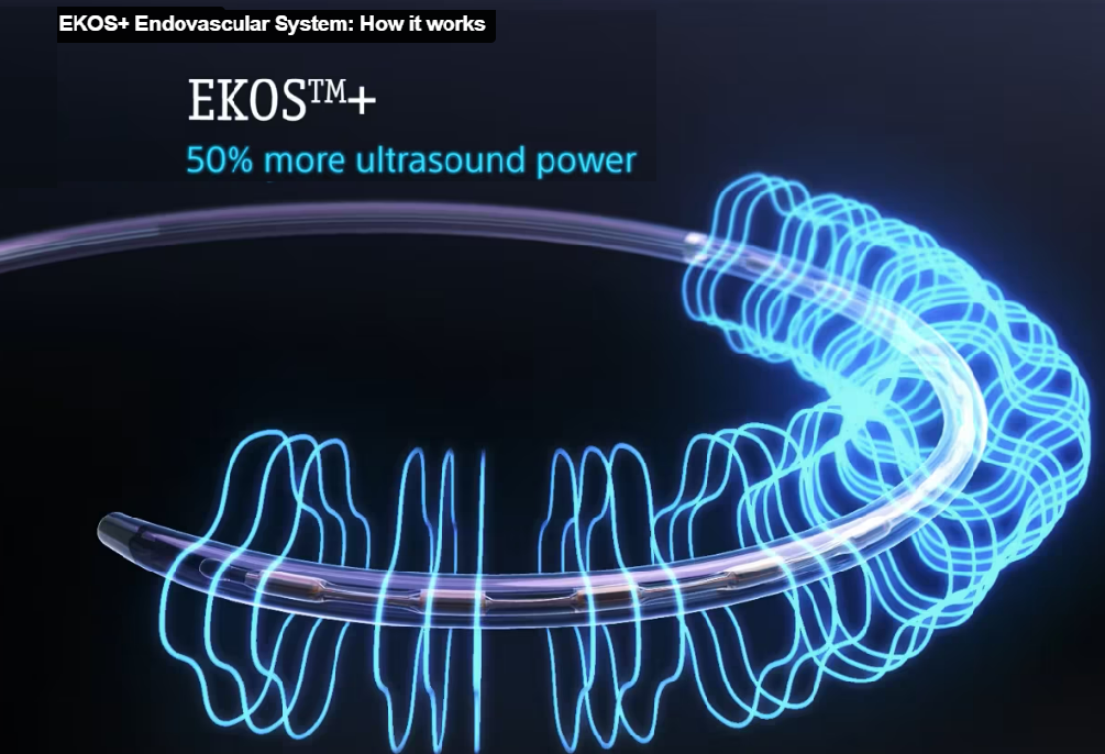 Boston Scientific H74939605106080 EKOS™+ Endovascular System, 7.8 Fr X ...